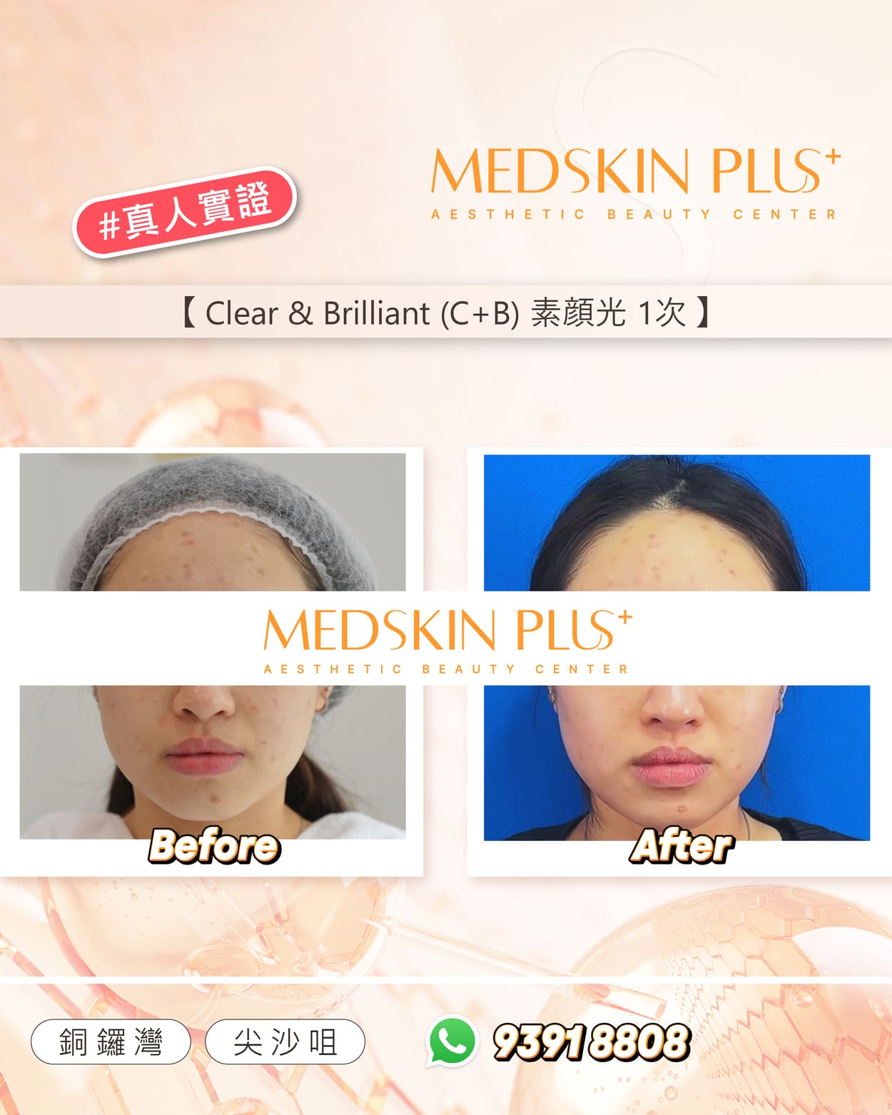 Clear & Brilliant 素顏光：溫和分段激光，煥發透亮光澤肌 – Medskin Plus
